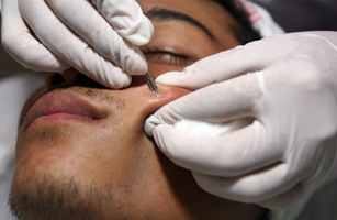 Parsing the Link Between Acne and Depression | TIME.com