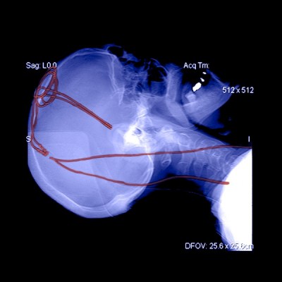 Study: Zapping the Brain Boosts Memory | TIME.com