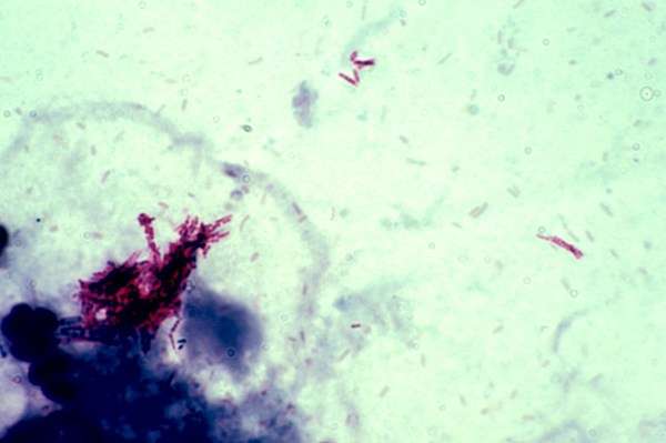 Study: Drug-Resistant Tuberculosis Still a Global Threat | TIME.com